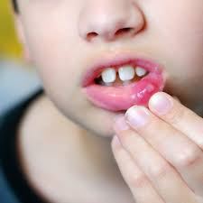 Is Toothpaste Incredible For Cold Sores