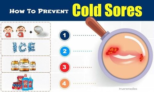 How To Stop A Cold Sore When It First Starts