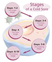 How To Stop A Cold Sore When It First Starts